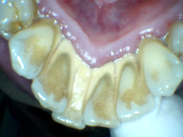 When was your last dental clean? - Ipswich Dental