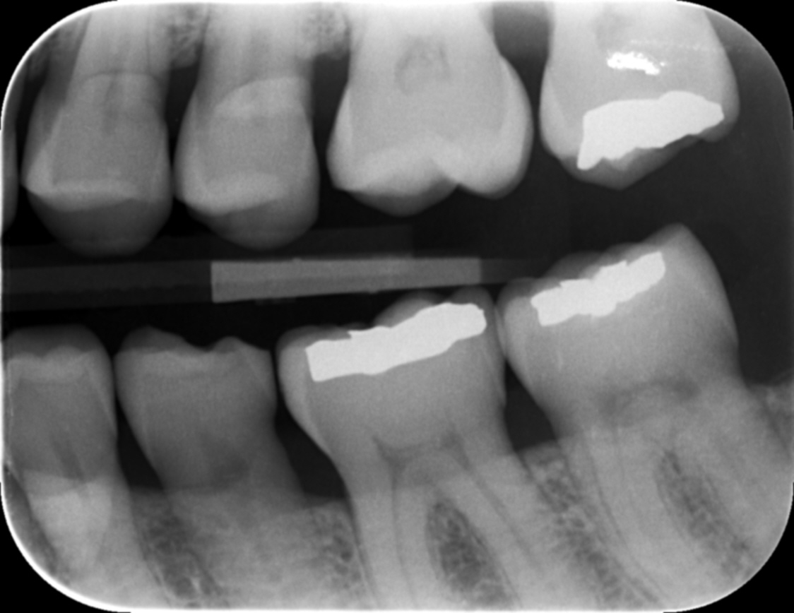 When was your last dental clean? - Ipswich Dental