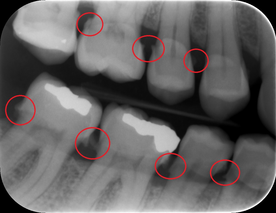 When was your last dental clean? - Ipswich Dental