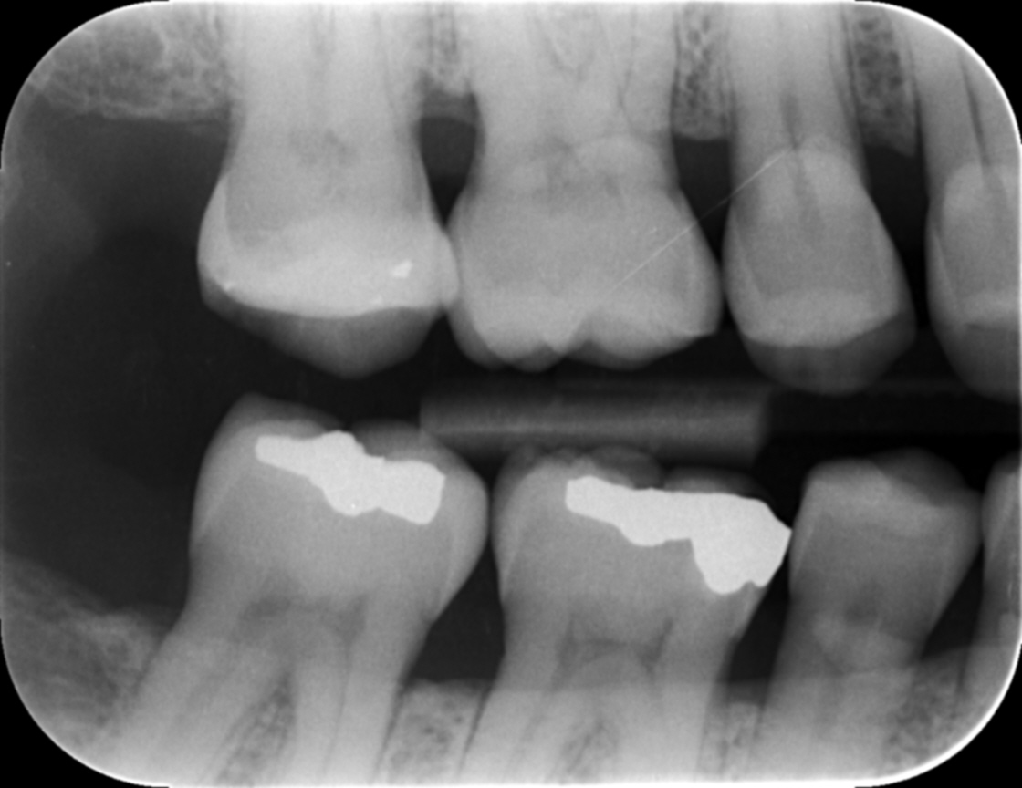 When was your last dental clean? - Ipswich Dental